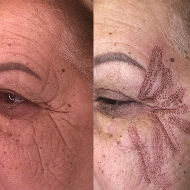 Fibroblast Plasma Skin Tightening in Stuart & Delray Beach | Non ...