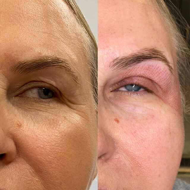 Fibroblast Plasma Skin Tightening in Stuart & Delray Beach | Non ...