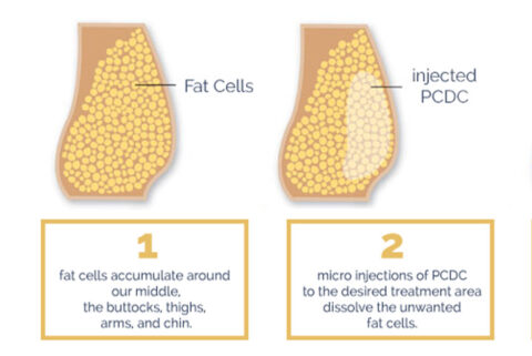 Fat Dissolve – injection – NSO Lab