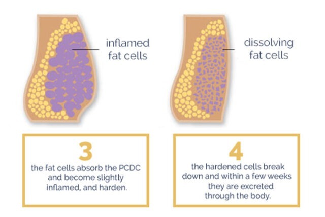 Fat Dissolve Injections in Stuart & Delray Beach, FL | Non-Surgical Fat ...
